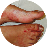 Micosis y Dermatosis inflamatorias del pie | ISDIN