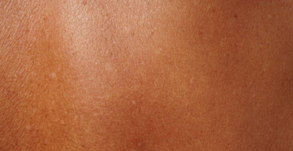 Sun Allergy Q&A: What to Know Before Summertime | ISDIN