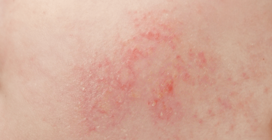 Todo sobre la cuperosis: descubre qué es y cómo tratarla - ISDIN