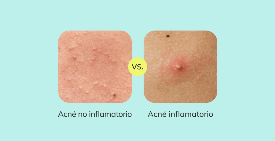 El acné en todas sus formas: identificando tipos y encontrando soluciones - ISDIN