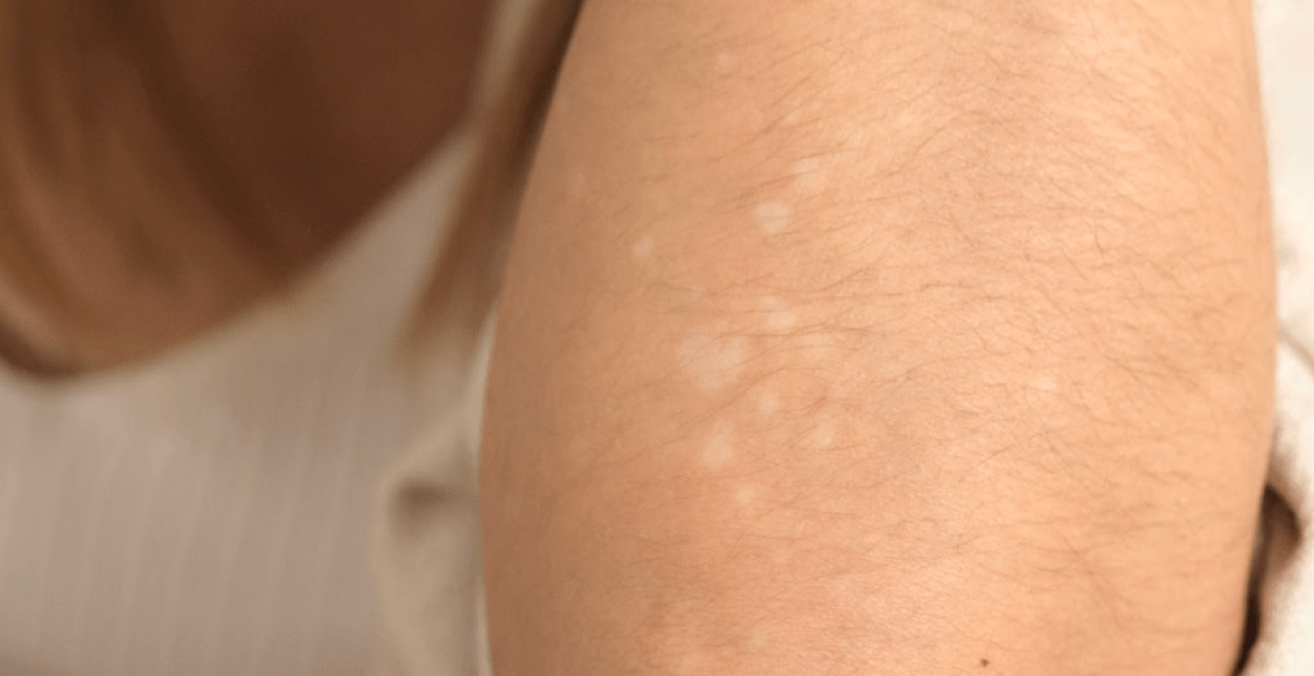 Entendiendo la psoriasis: qué es y por qué aparece - ISDIN