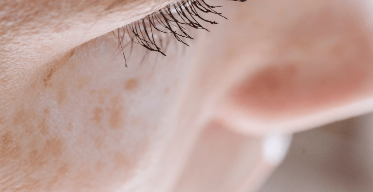 ¿Manchas en la piel? Respondemos a tus preguntas - ISDIN