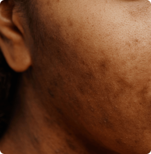 What is photoaging? Everything you need to know - ISDIN's blog