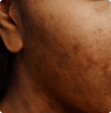 What is photoaging? Everything you need to know - ISDIN's blog