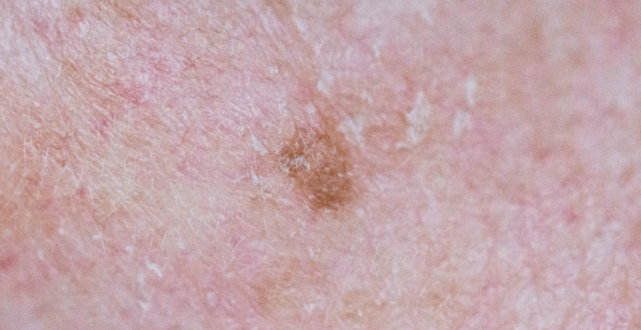 What Is Actinic Keratosis & How to Help Protect Yourself | ISDIN