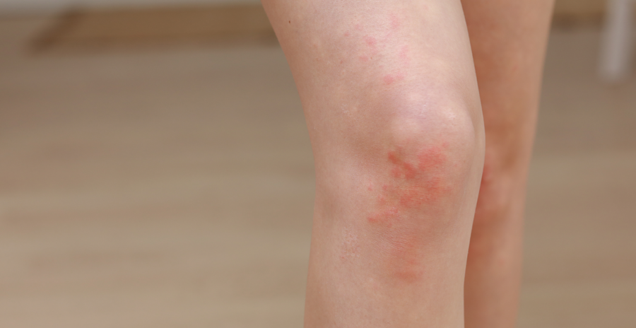 What Is Atopic Dermatitis (AKA Eczema)? | ISDIN