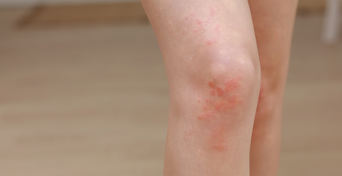 What Is Atopic Dermatitis (AKA Eczema)? | ISDIN